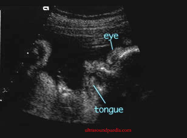 new cleft Object Detection Model by DEFECT