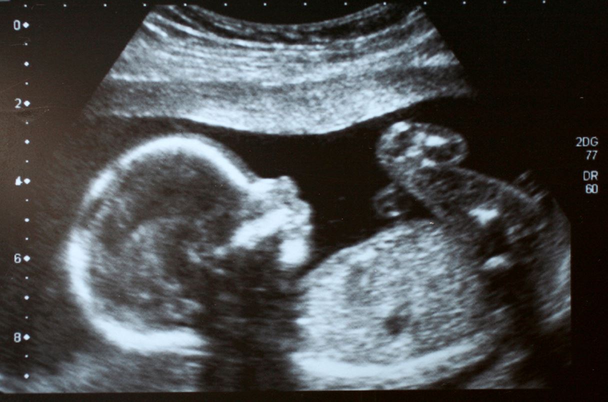 Cleft Lip and Palate Ultrasound Imaging Instance Segmentation Model by ...