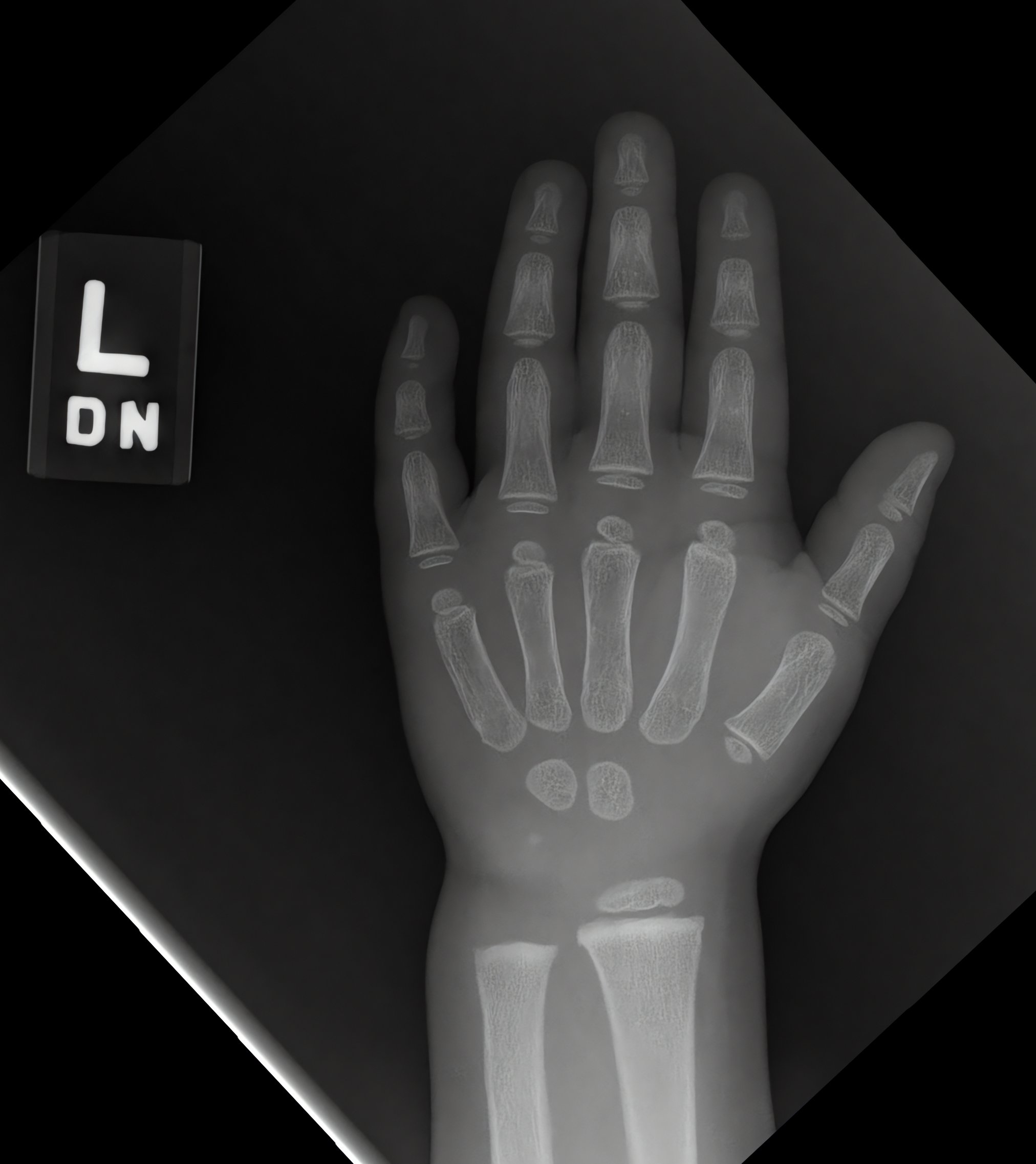 cropping_hand Object Detection Dataset and Pre-Trained Model by boneage