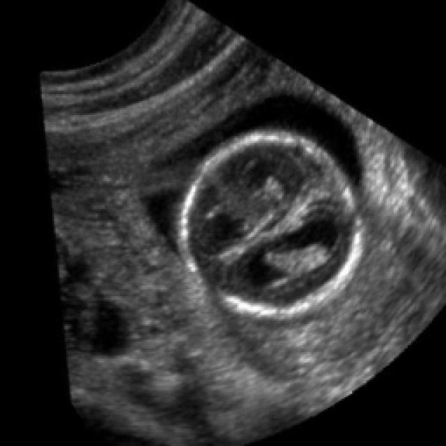 Fetal Brain Abnormalities Ultrasound Classification Model by nidhi