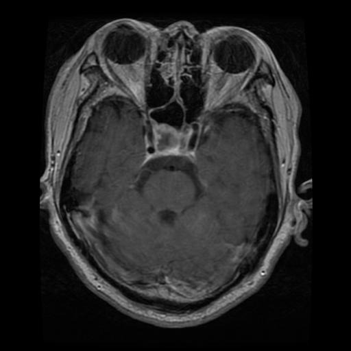 brain tumor v10 Object Detection Dataset by brain tumor detection using ...