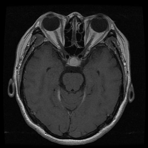 brain tumor Object Detection Dataset by brain tumor detection using yolov11