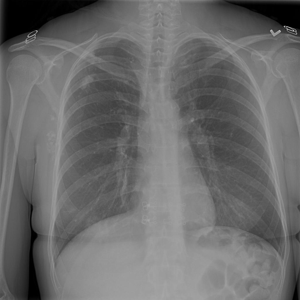 Nih Xray Fsod Hhze Object Detection Dataset By Rf100vltemp