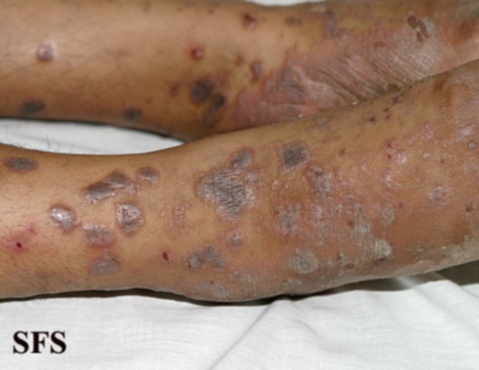 skin_segment Instance Segmentation Dataset by Skindisesediagnosis