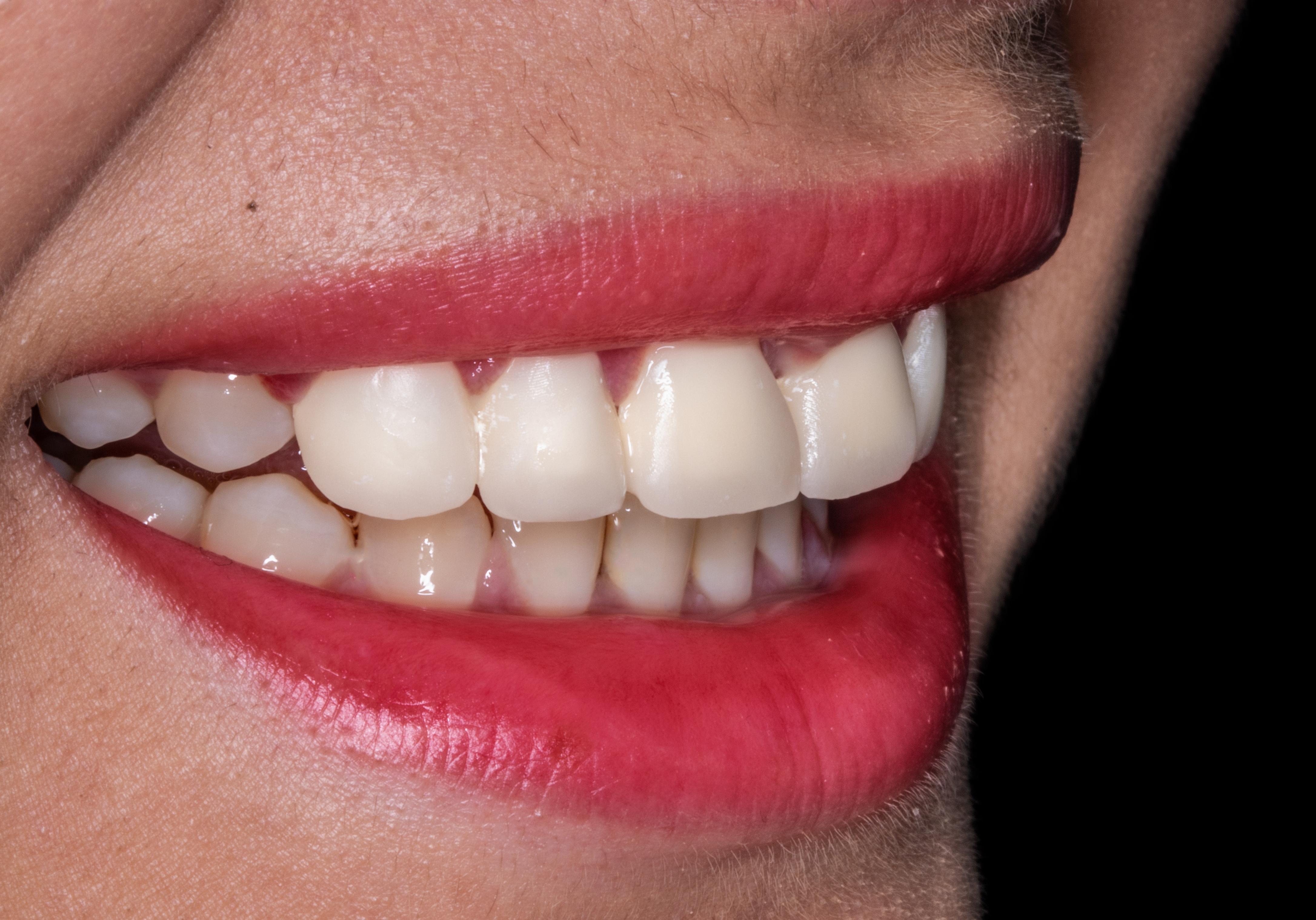 Caries Object Detection Model By Seecs