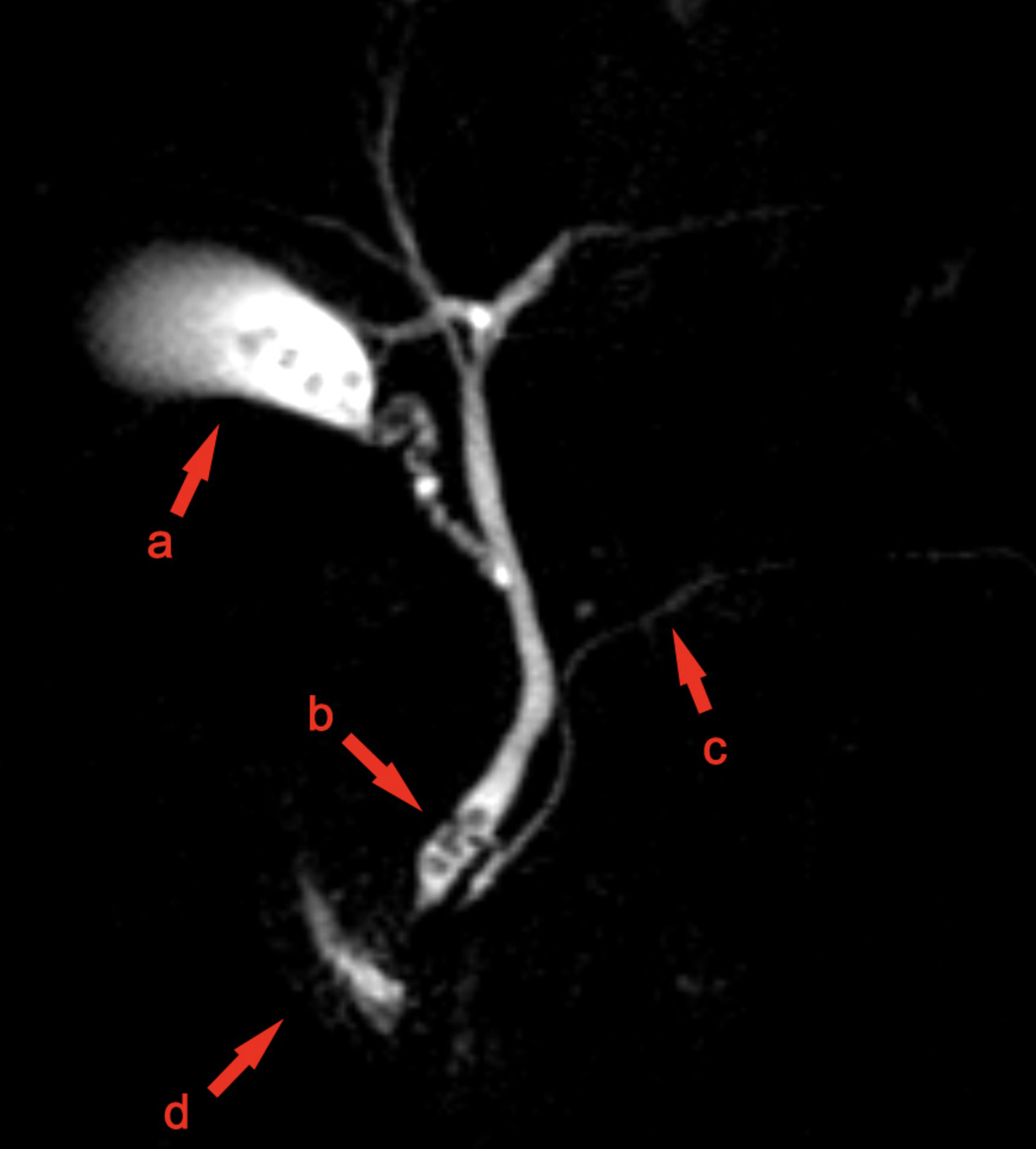 MRCP Instance Segmentation Dataset by Surgery Database