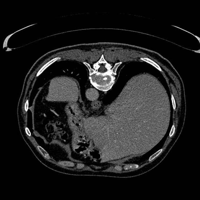 Tumor Liver Fajar Object Detection Dataset By Fajar Firmansyah
