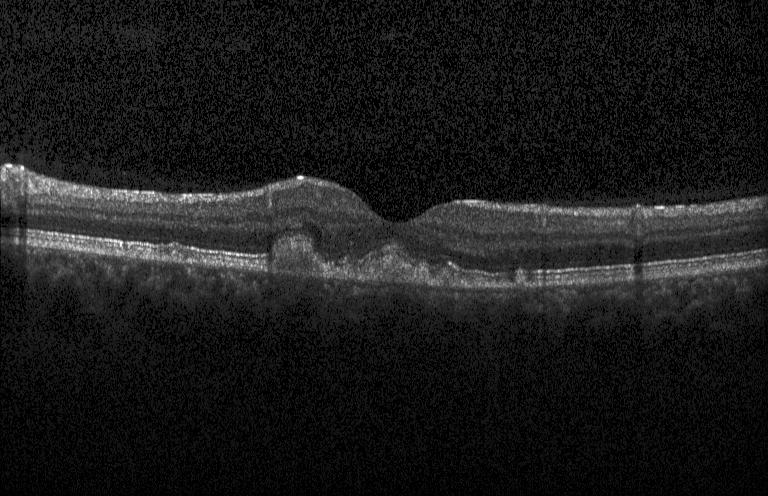 How to Use the Retinal classifaction Classification API