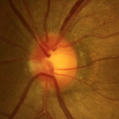 glucoma Classification Model by EYE DISEASE RP
