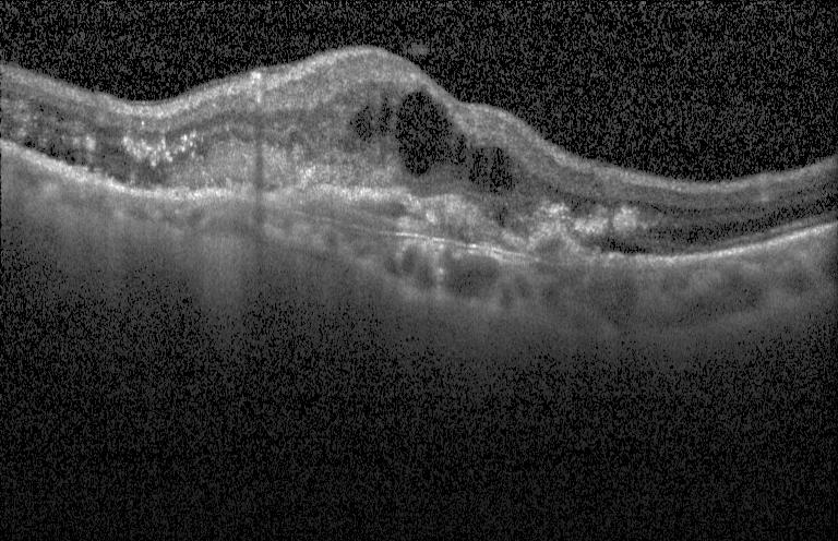 AMD new OCT Classification Model by EYE DISEASE RP