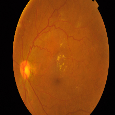 Retinal classifaction Classification Model by EYE DISEASE RP
