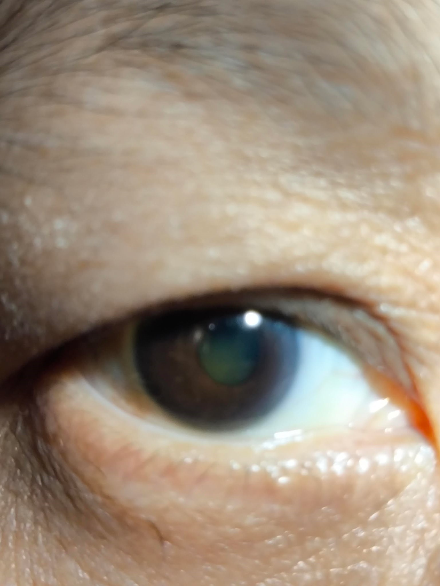 test-cataract Classification Dataset (v7, 2024-12-06 10:33pm) by ...