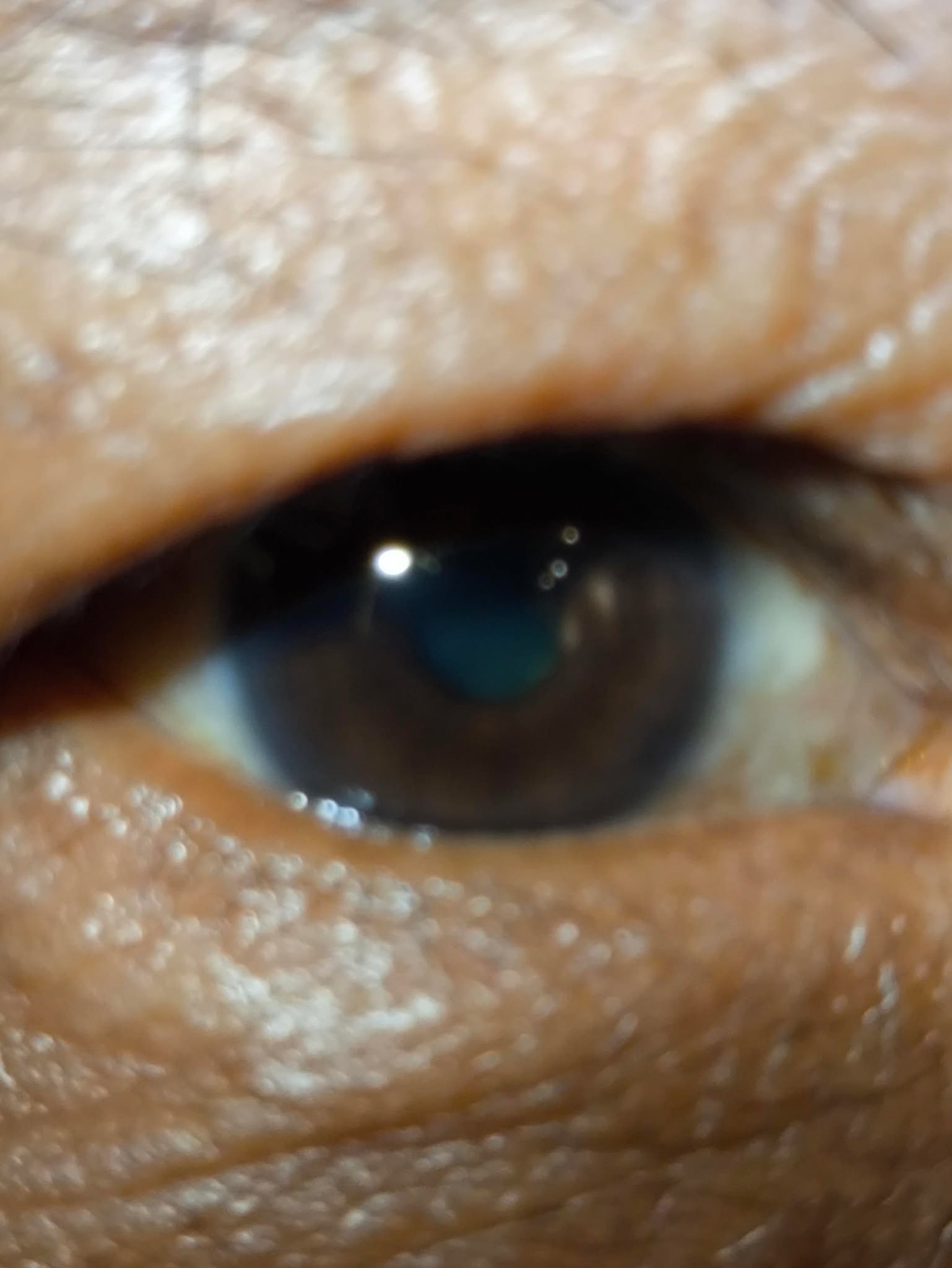 Cataract Detection Object Detection Dataset By Crowdmanagement