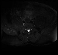 Axial Spinal Cord Detection Object Detection Model by Lumbar Spine