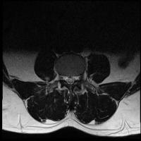 Axial Spinal Cord Detection Object Detection Model by Lumbar Spine