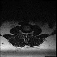Axial Spinal Cord Detection Object Detection Model by Lumbar Spine