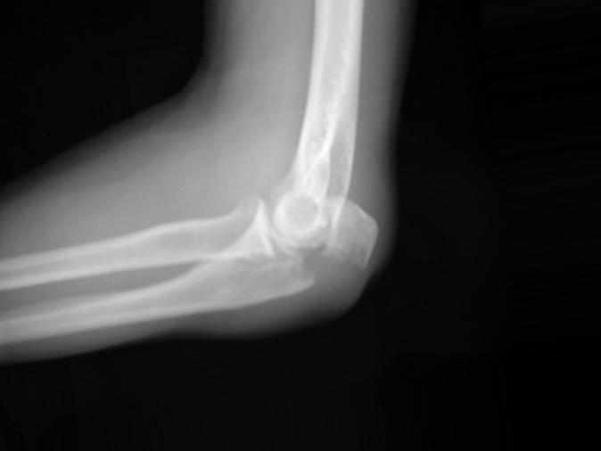 How To Use The Bone Fracture Detection Object Detection Api 2775