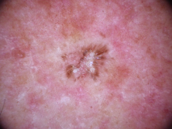 Skin Lesion Segmentation Instance Segmentation Model by Hussain Mahmood