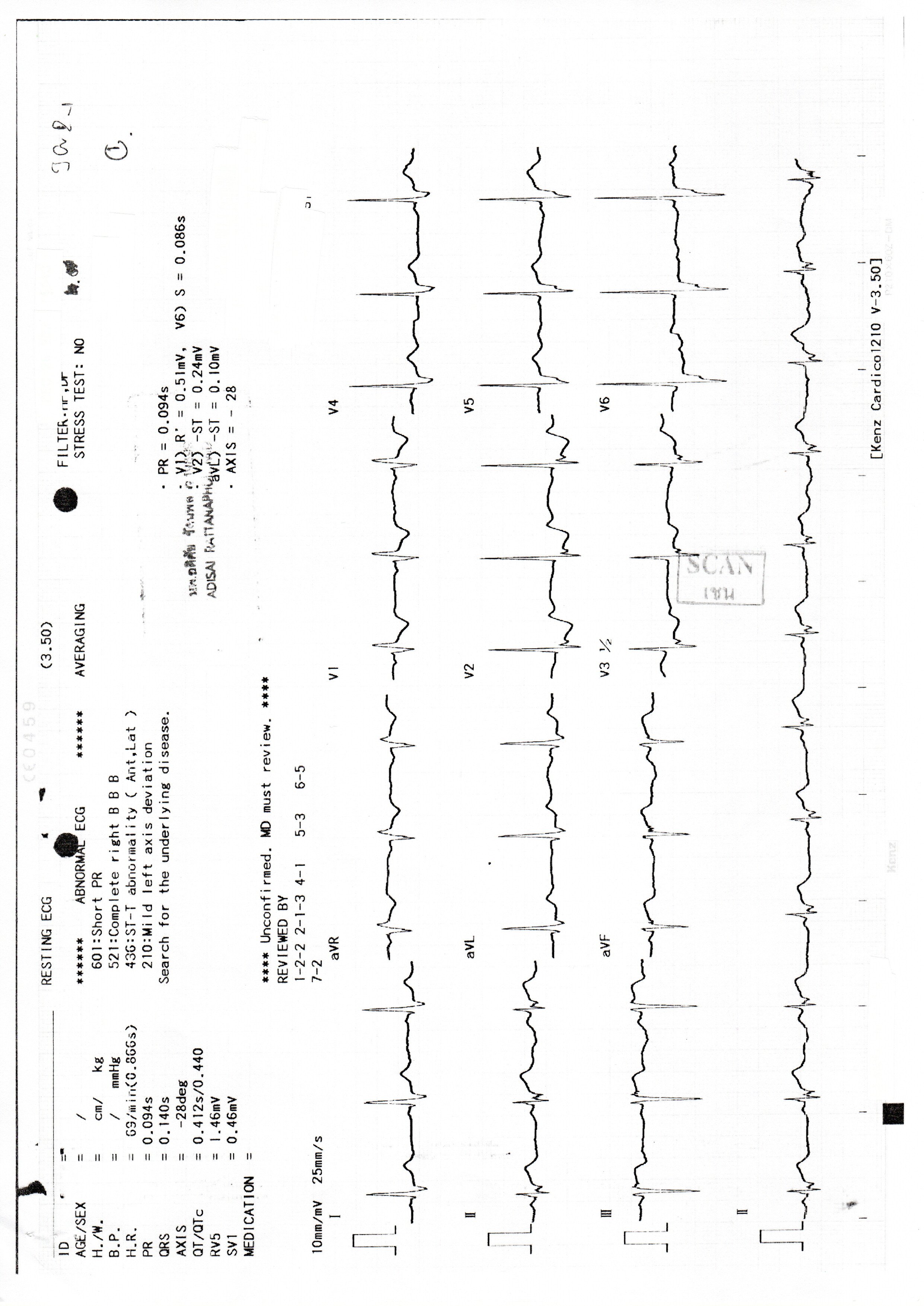 stemi-detection Object Detection Model by prince