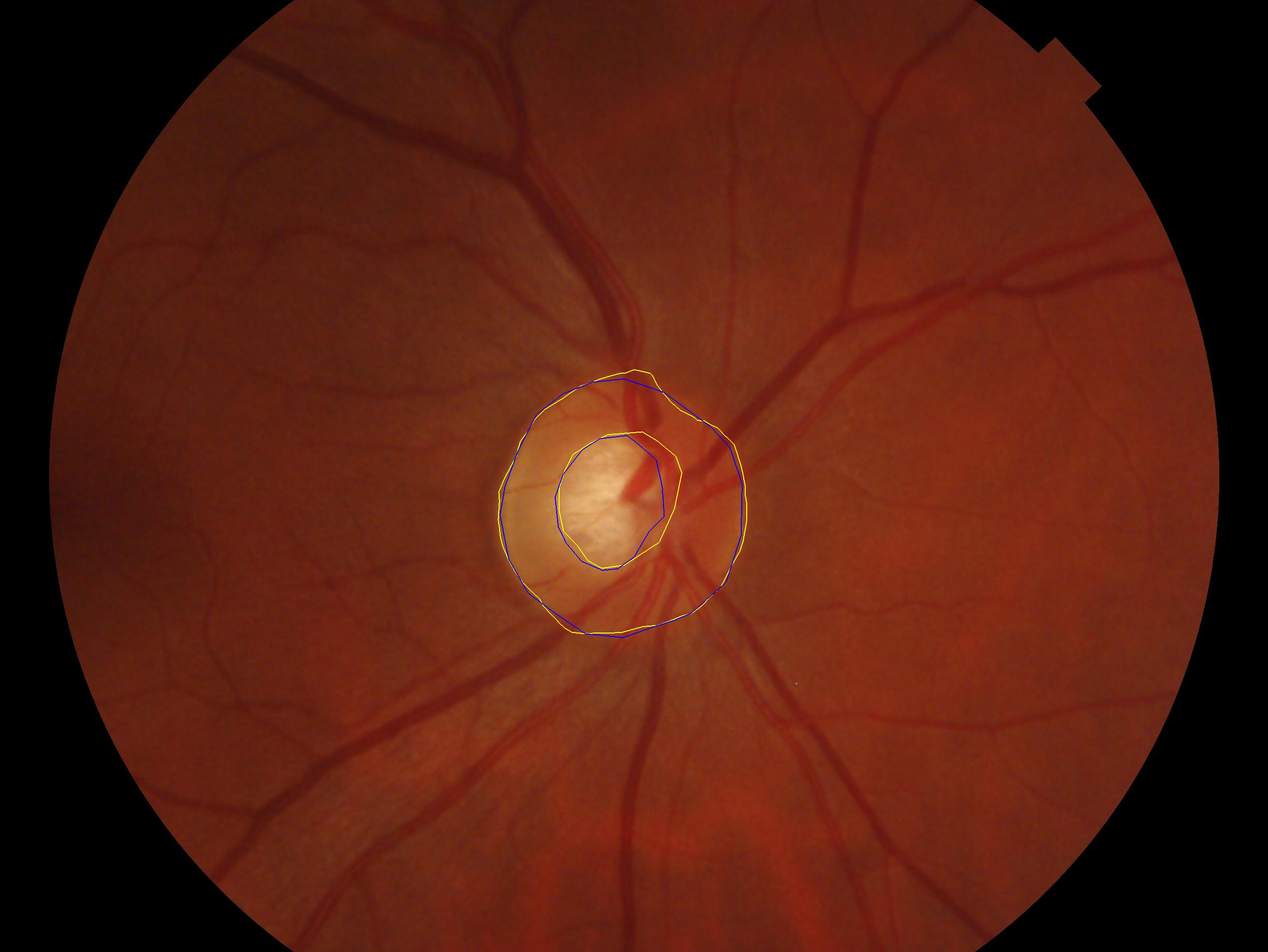 Glaucoma Segmentation Instance Segmentation Dataset And Pre Trained Model By Nvdvinn