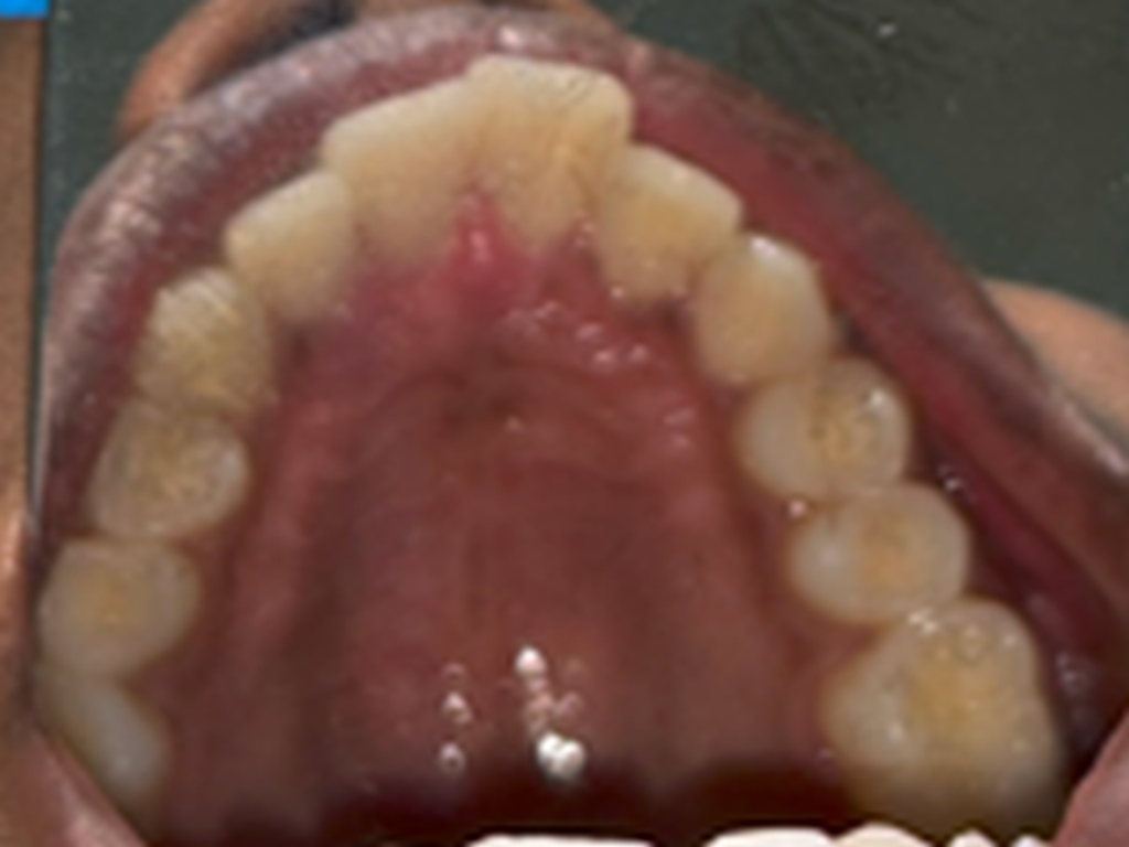 Healthy Teeth Object Detection Model by Sultan