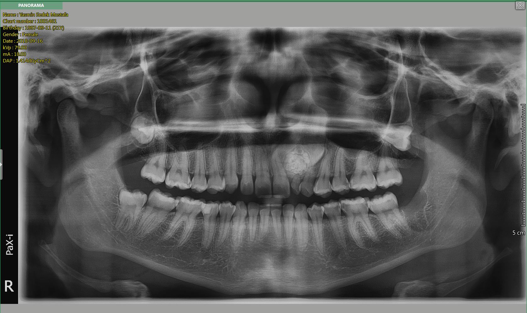 Impacted canine Object Detection Dataset and Pre-Trained Model by ...
