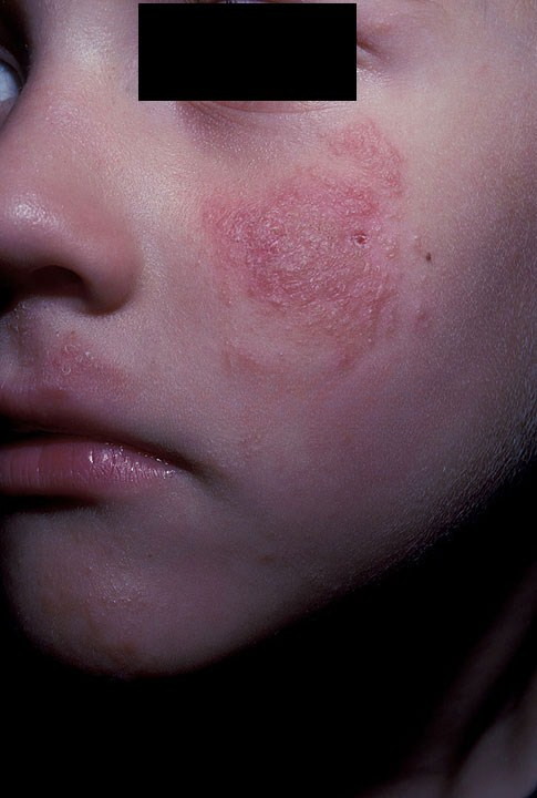 Lupus Object Detection Dataset By Project