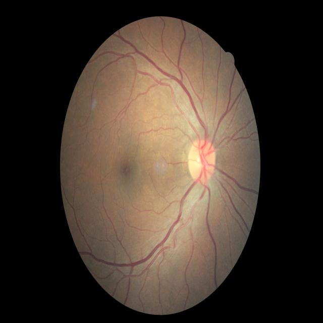 Eye pac balanced class Classification Dataset by Eyes Classification