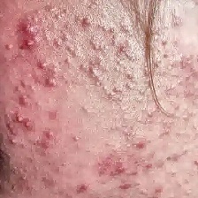 acne_detection Object Detection Dataset and Pre-Trained Model by acne