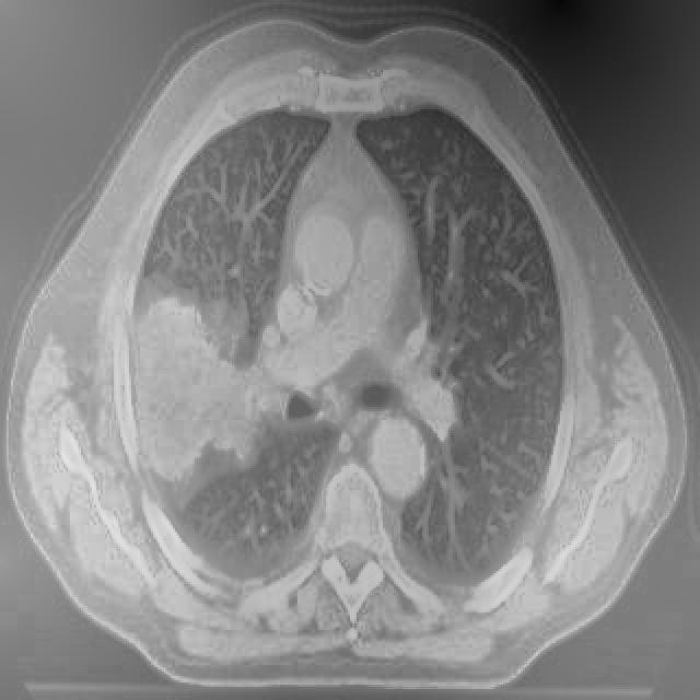 Lung Cancer Classification Dataset By Unitec