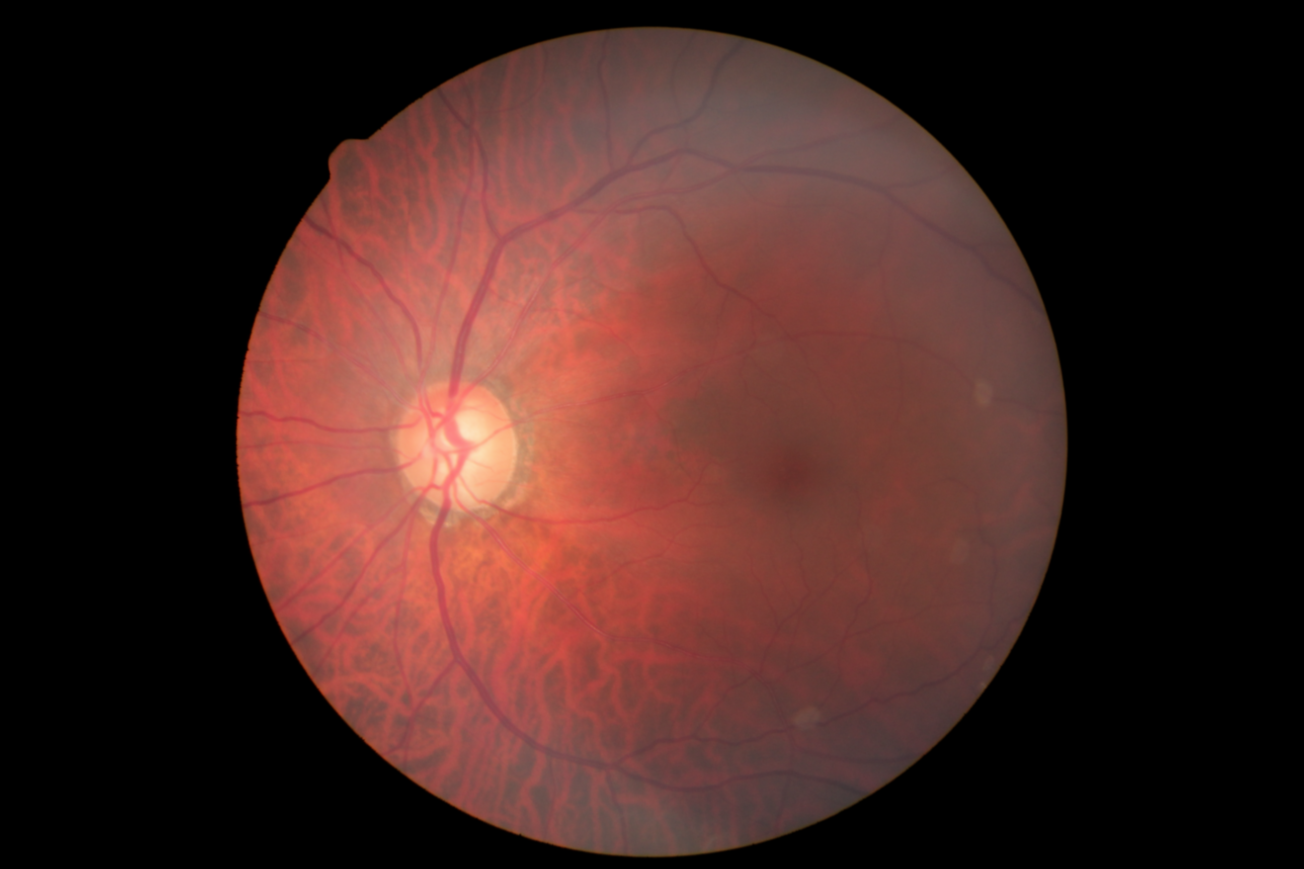 eye-disease Instance Segmentation Dataset by eye