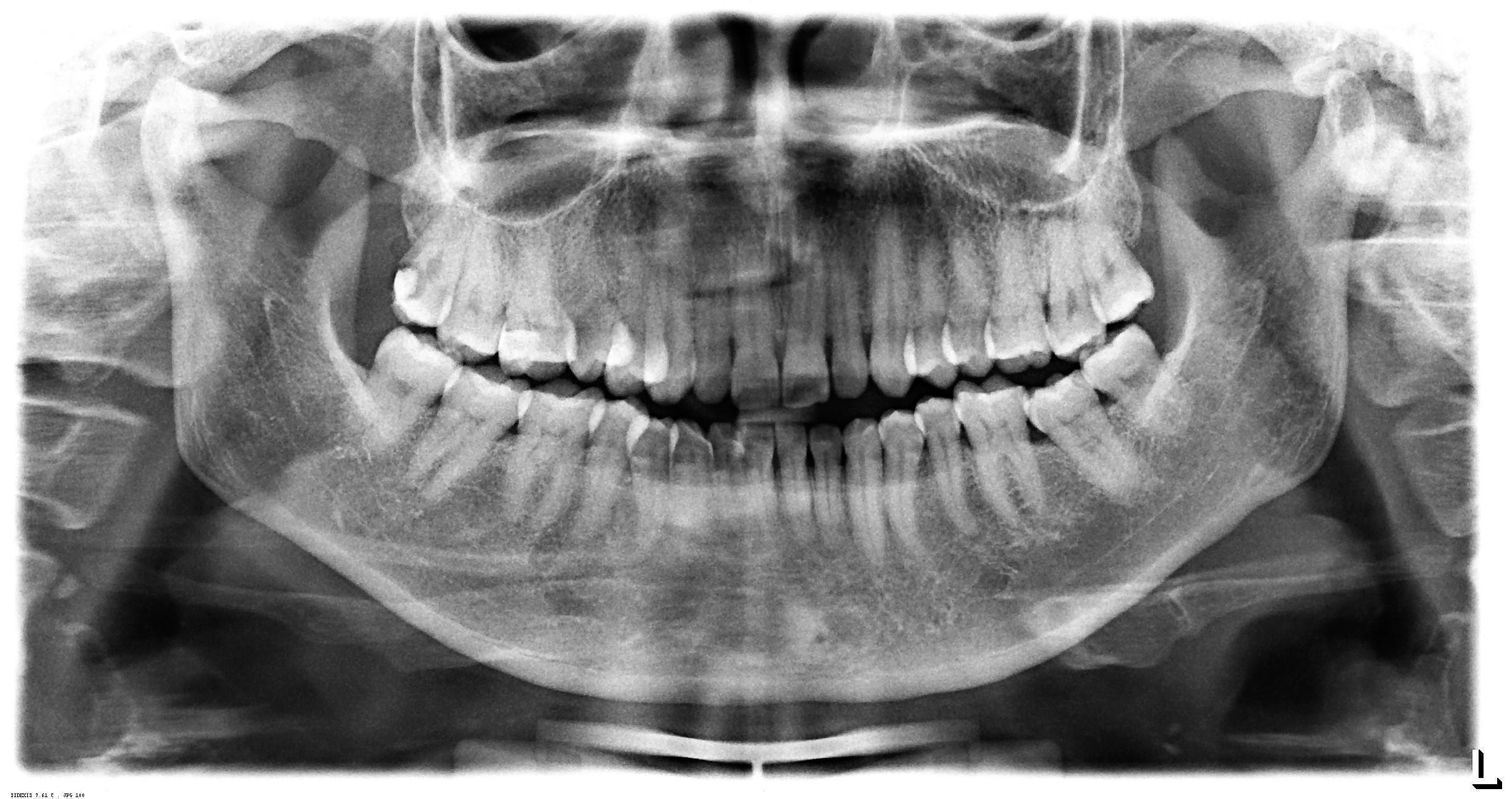 Teeth Segmentation Instance Segmentation Model by MyWorkspace