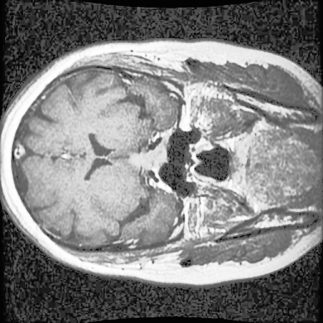 brain-tumor-segmentation Instance Segmentation Dataset and Pre-Trained ...