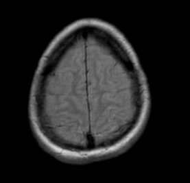 Updated Mri based brain stroke Object Detection Model by Project