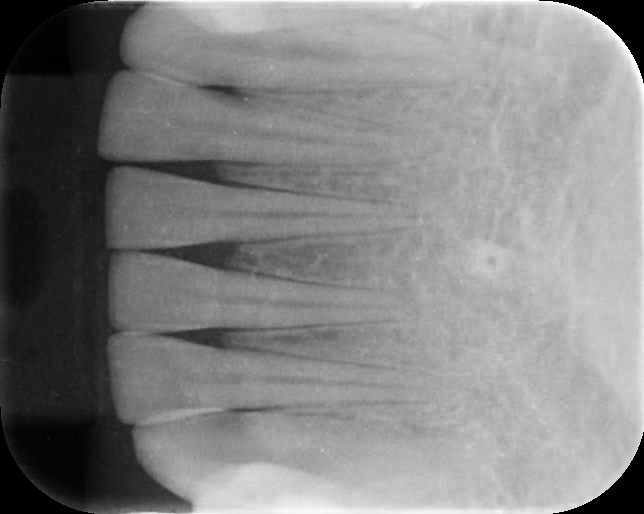 DENTAL Object Detection Model by ZeuS