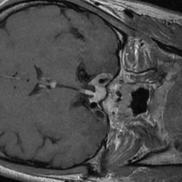 Brain Tumor Detection Object Detection Dataset By Project