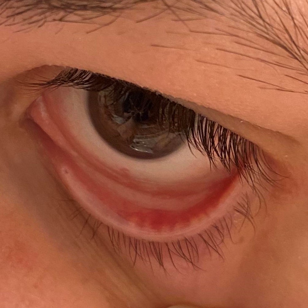 Conjunctiva_Segment_1 Instance Segmentation Dataset (v1, 2024-03-02 12:41am) by Conjunctiva ...