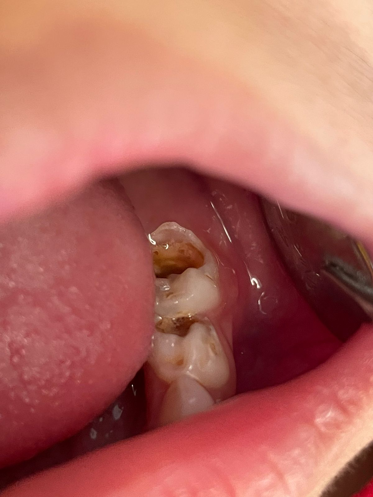 caries Object Detection Dataset and Pre-Trained Model by Universitas Muslin Indonesia