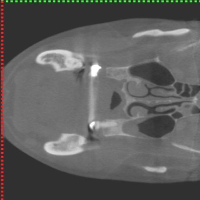 NASAL_BONE Object Detection Model by krishnaji