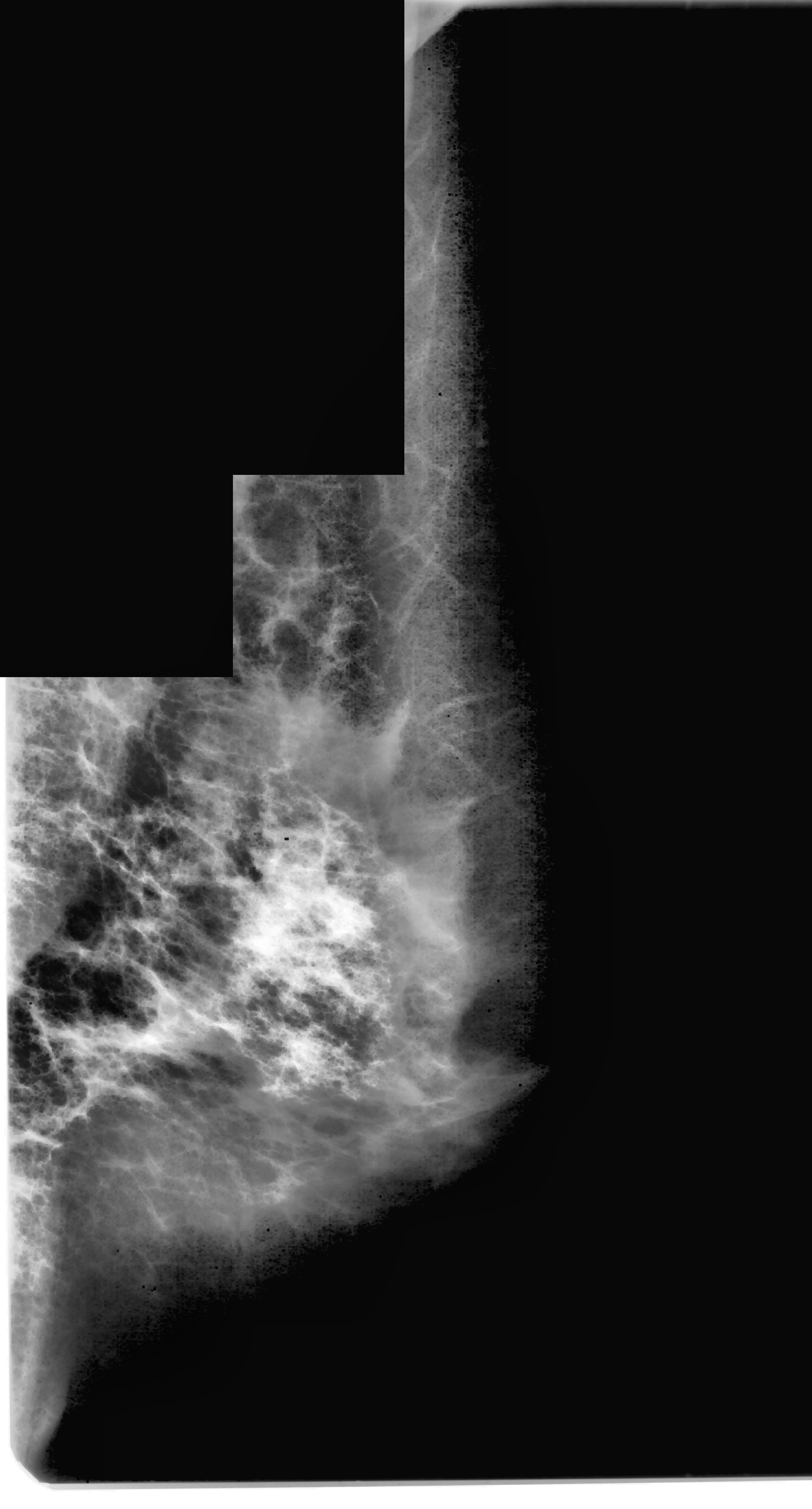 Breast Cancer Object Detection Dataset By Yolo5objectdetection