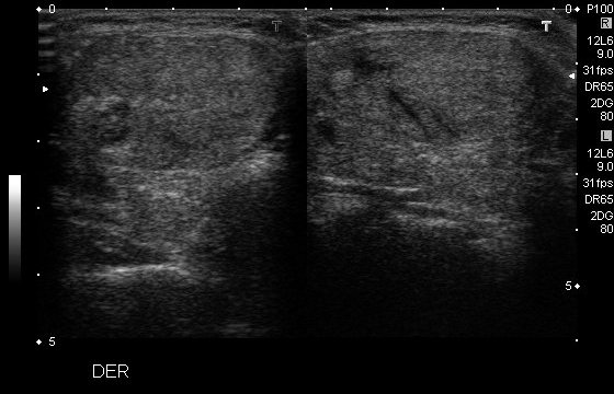 Thyroid Detection Object Detection Dataset And Pre Trained Model By