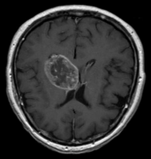 Tumor Detection Object Detection Dataset And Pre Trained Model By