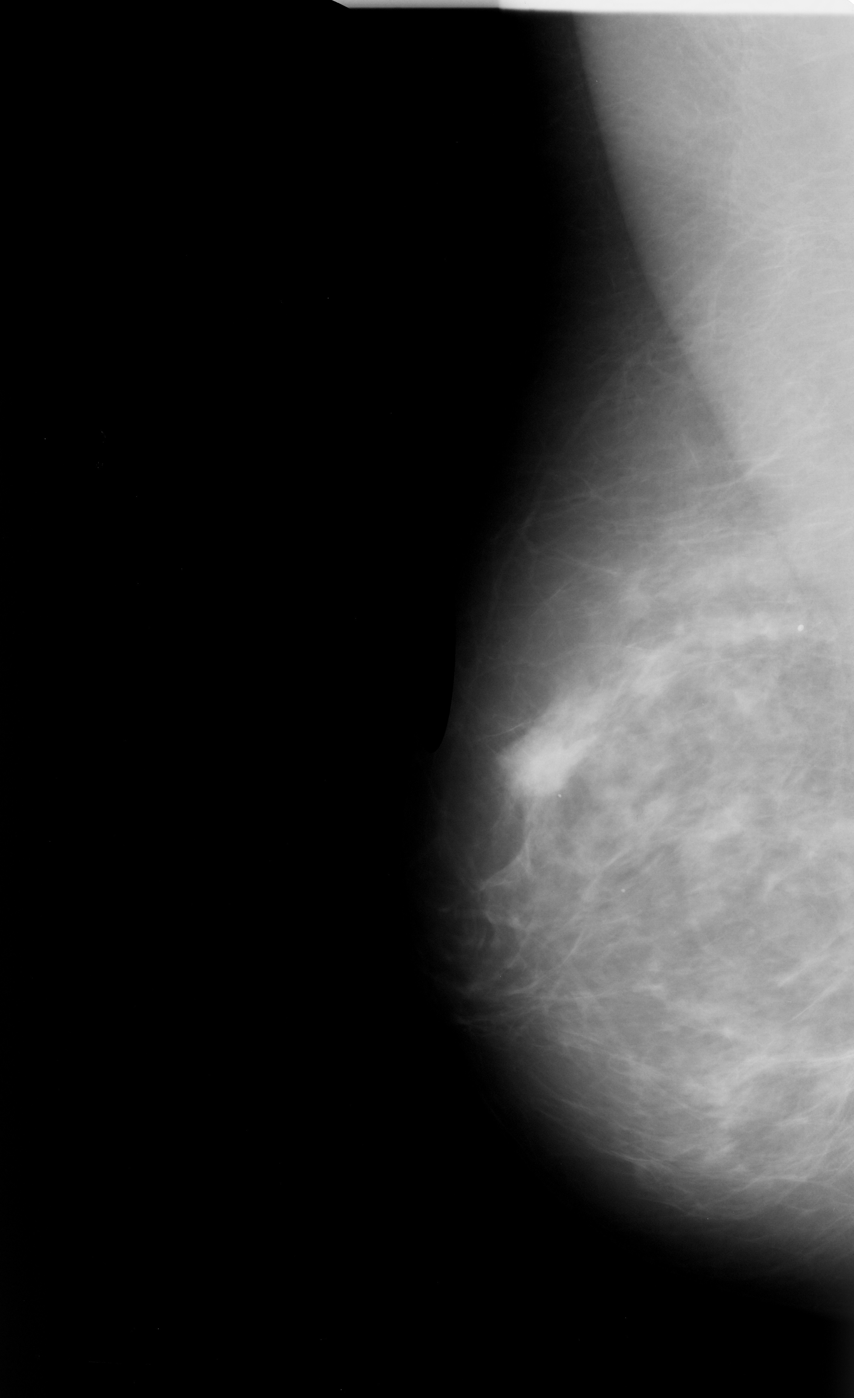 Breast Cancer Detection 1 Object Detection Dataset By Yolo5objectdetection