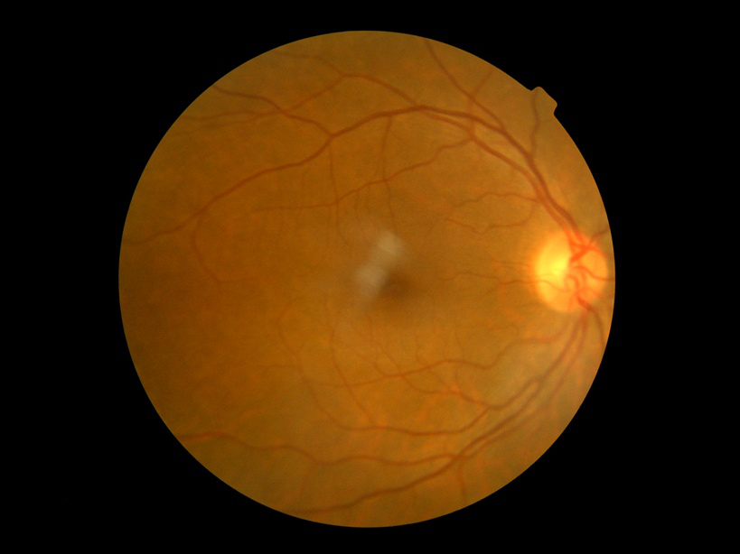 Dibetic Retinopathy 2 Object Detection Model by syed azizul alam