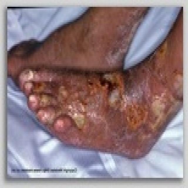 Diabetic Wounds Object Detection Model by THSBCS2