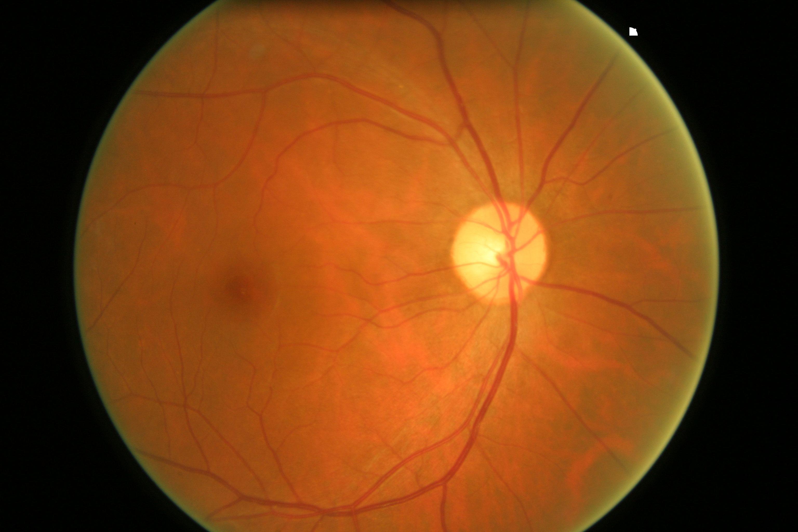 glaucoma_prediction Classification Model by glaucoma