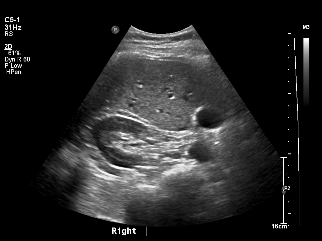 kidney_cancer Object Detection Dataset by ThomasRoboFlow