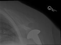 Bone Fracture Detection (bone-fracture-detection-tilqq) - Roboflow Universe