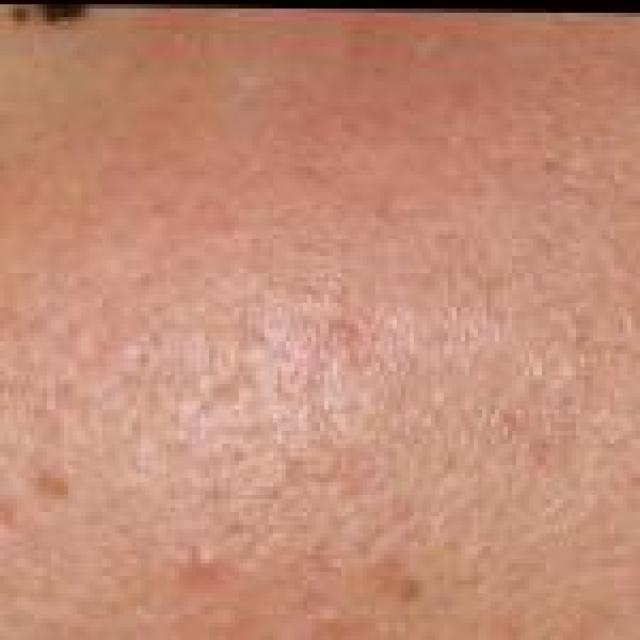 Acne Scanner Classification Model by AcneScan