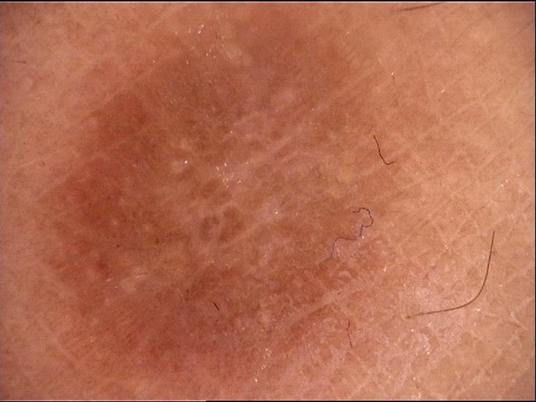 Skin cancer Object Detection Dataset and Pre-Trained Model by Anjali patel